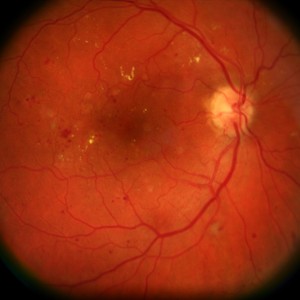 Diabetic Retinopathy | Diabetic Retinopathy Symptoms | VIM