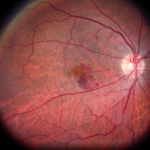 Macular Degeneration | Macular Degeneration Treatment | VIM